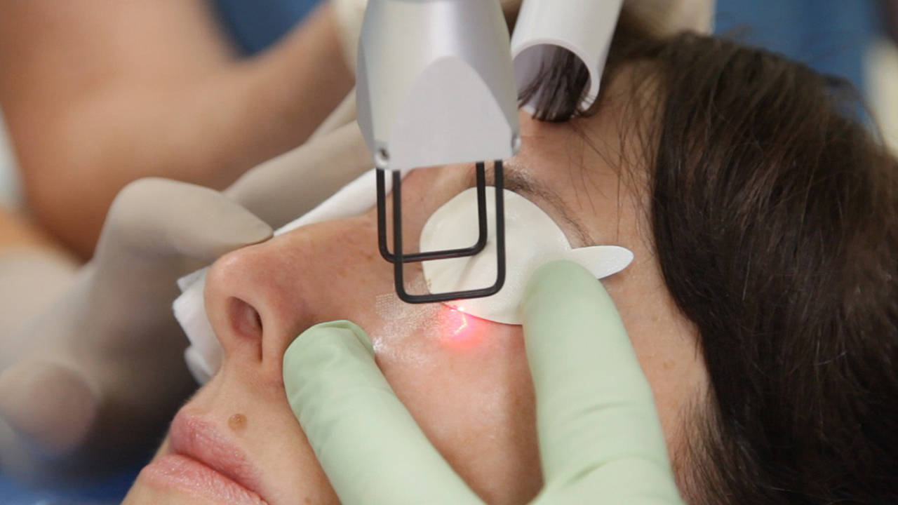 Hair Removal and Laser Treatments in Brighton, Worthing & Hove - Laser ...